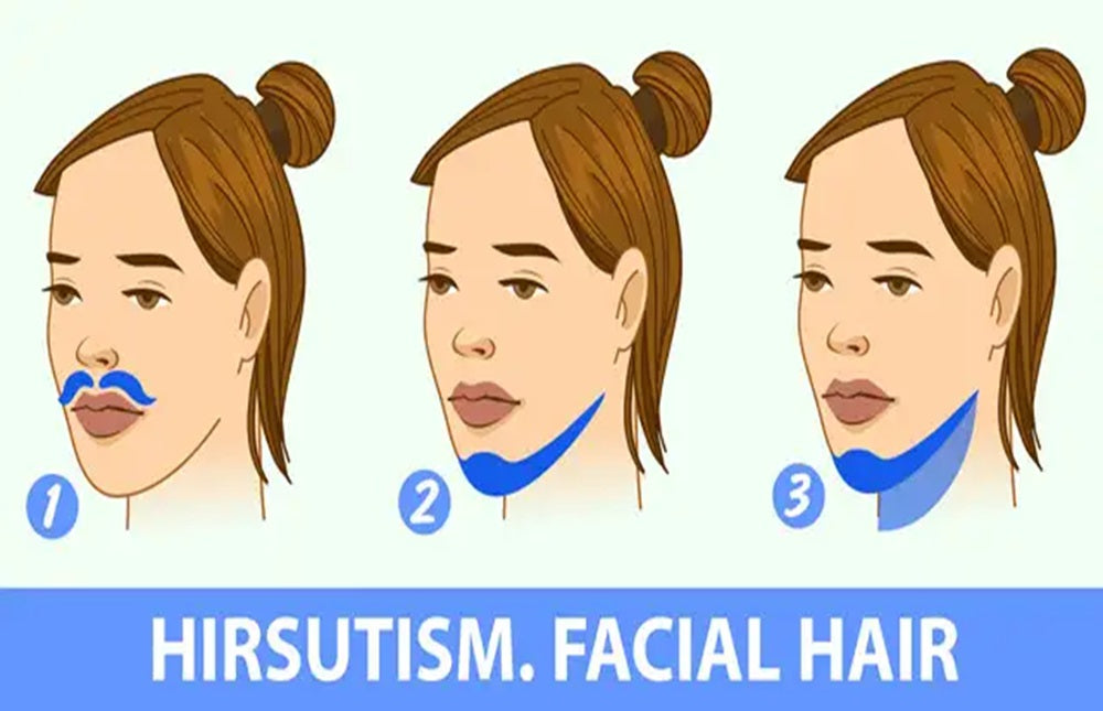 The Hidden Link Between PCOS and Facial Hair Growth – Sois Life Sciences